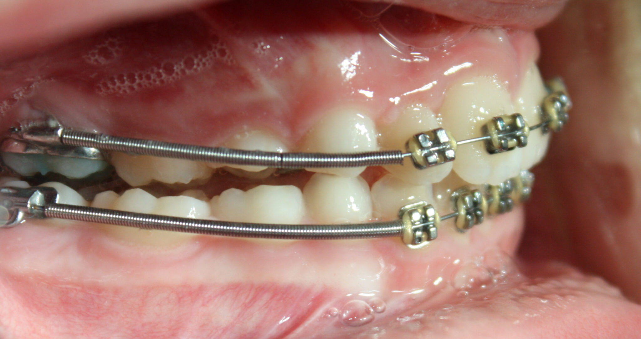 About Your Braces – Larkin Orthodontics